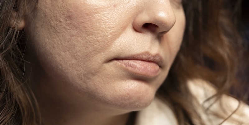 Subcision for Acne Scars - FCP Dermatology